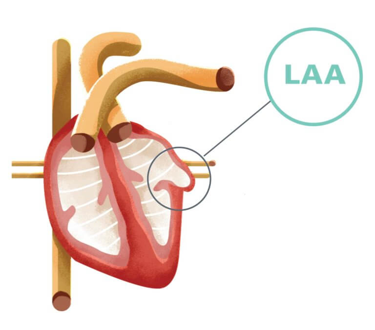 WATCHMAN FLX Pro AFib Implant - Cardiac Care | Singing River Health System