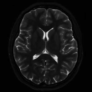 Advanced MRI: AIR™ Recon DL | Singing River Health System