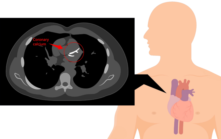 Cardiac CT for Calcium Scoring - Heart Testing | Singing River Health ...