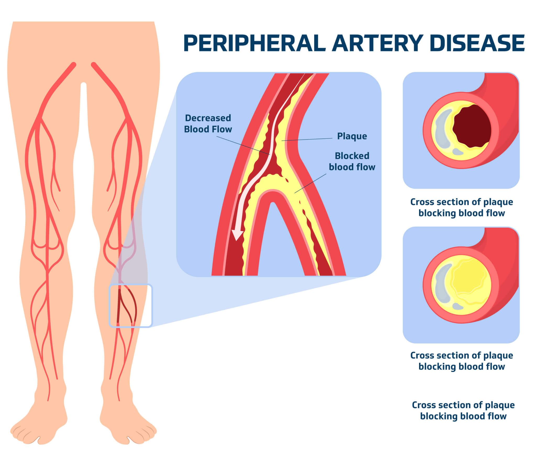 Peripheral Artery Disease - Cardiac Care | Singing River Health System
